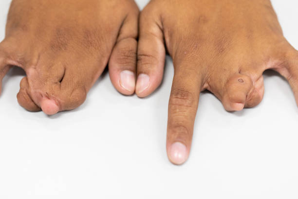 Congenital Hand Differences Treatment Specialist in Ahmedabad | Krisha ...