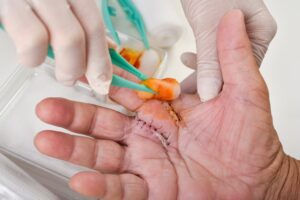 Soft Tissue Injuries of the Hand: Signs, Risks & Treatment