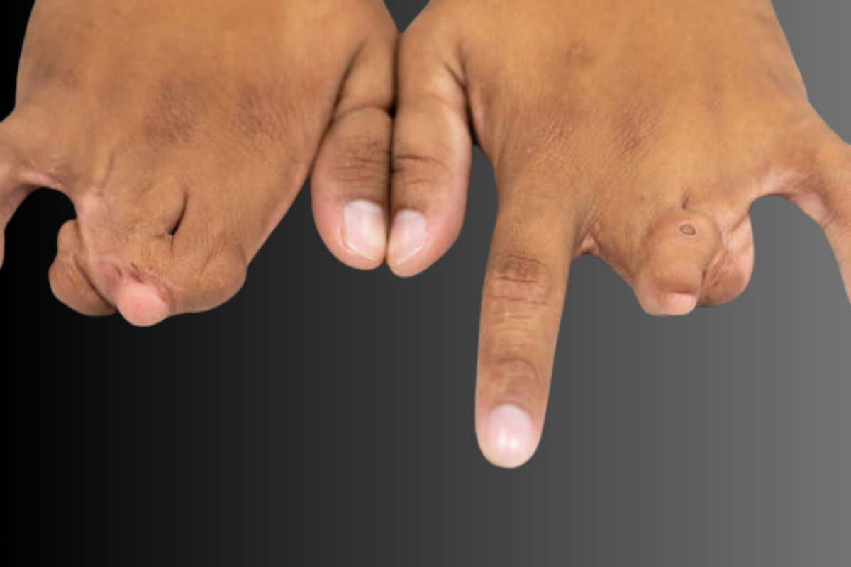 Best Hand & Wrist Surgery in Ahmedabad: Krisha Hand Hospital