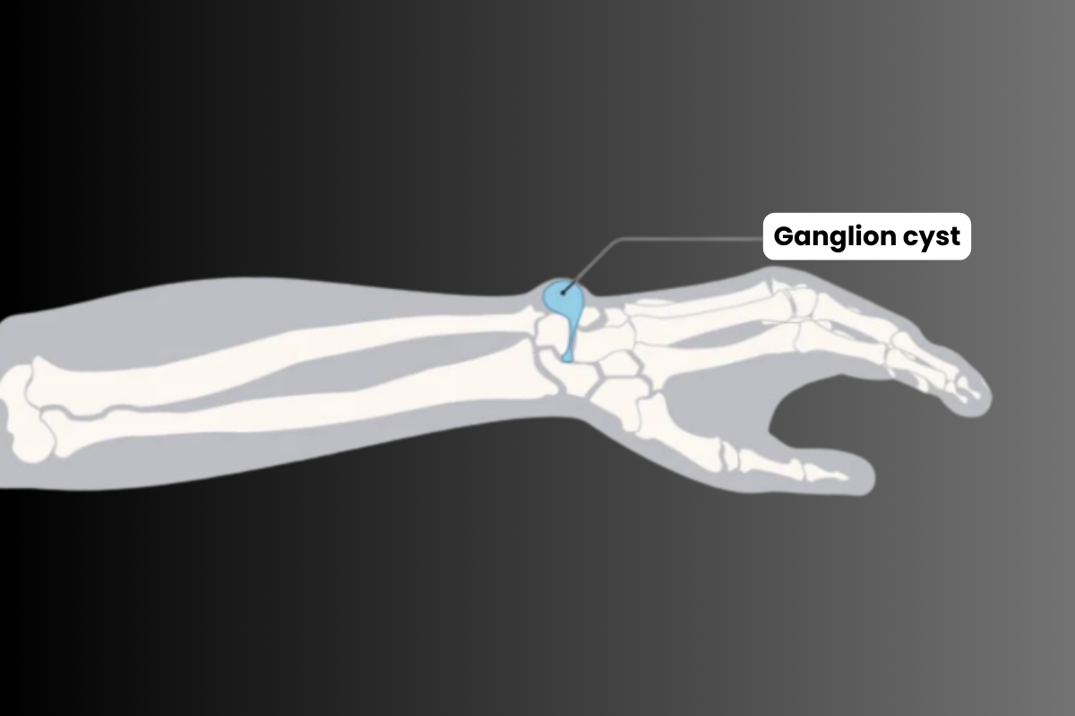 Best Ganglion Cyst Treatment in Ahmedabad