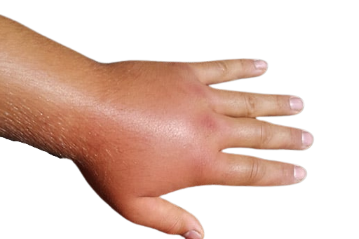 Best Hand Swelling Treatment in Ahmedabad