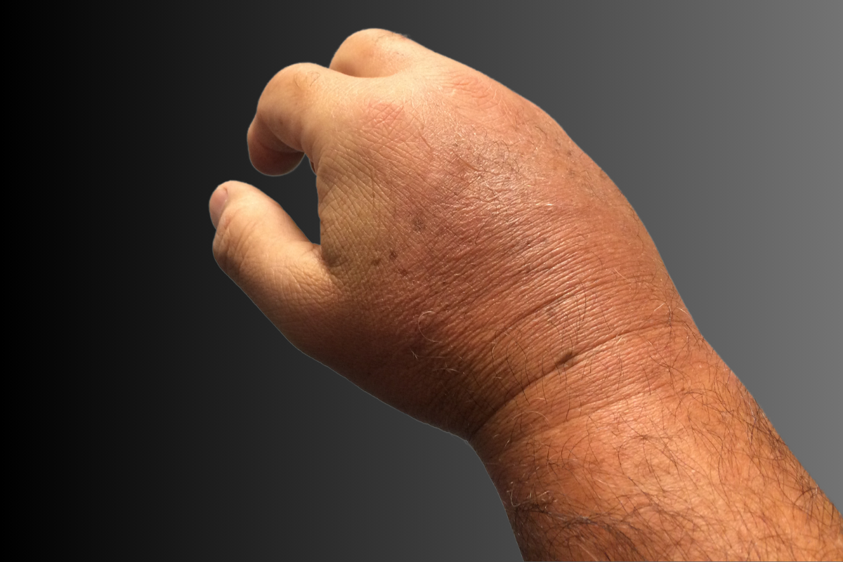 Best Hand Swelling Treatment in Ahmedabad