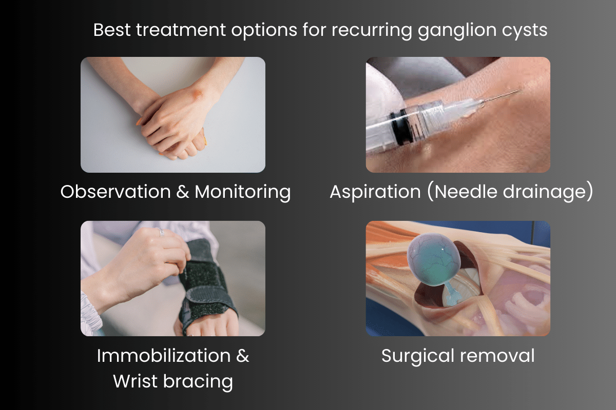 What to do if a ganglion cyst comes back after surgery?