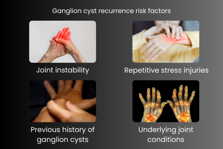 What to do if a ganglion cyst comes back after surgery?