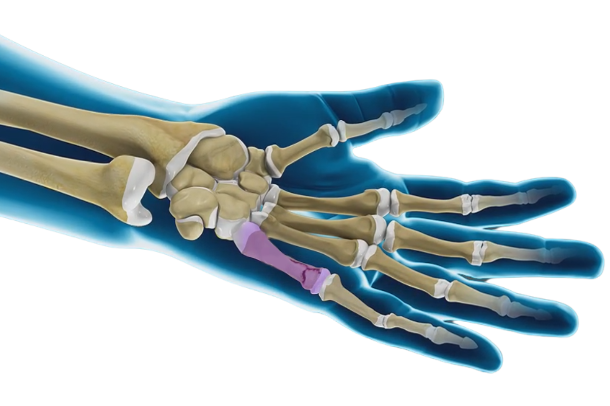Best Hand Fracture Treatment in Ahmedabad