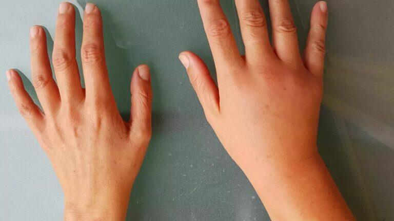 Finger Swelling: Causes and their treatments