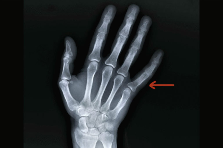 Soft Tissue Injuries of the Hand: Signs, Risks & Treatment