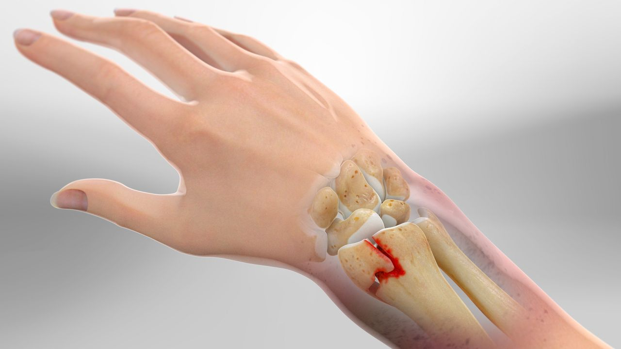 Wrist joint fracture: Symptoms, Causes, and Treatment options