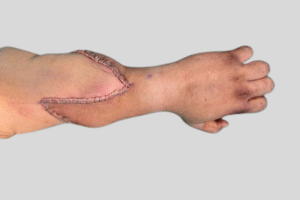Hand Transplant Surgery: Procedure, Recovery & Ideal Candidates