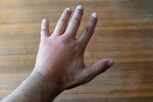 Soft Tissue Injuries of the Hand: Signs, Risks & Treatment