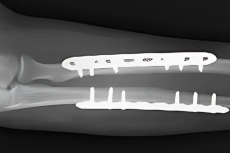 Best Hand Fracture Treatment in Ahmedabad