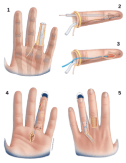 Best Hand Replantation in Ahmedabad